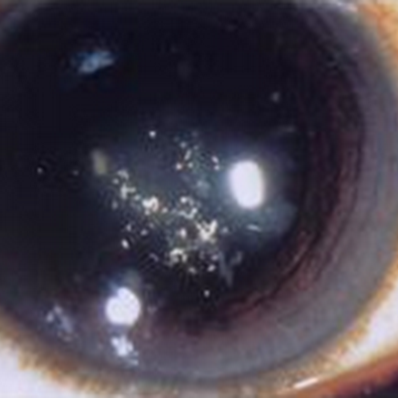 Oil Droplet Cataract